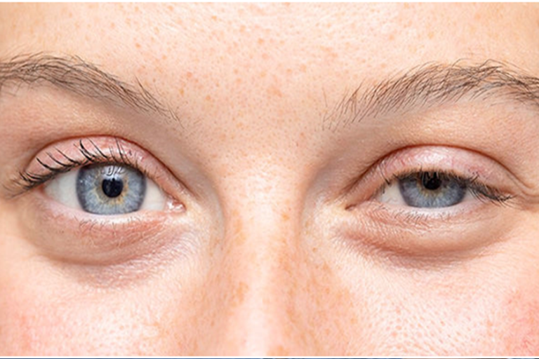 Ptose Palpebral - Dr. Mário Saad